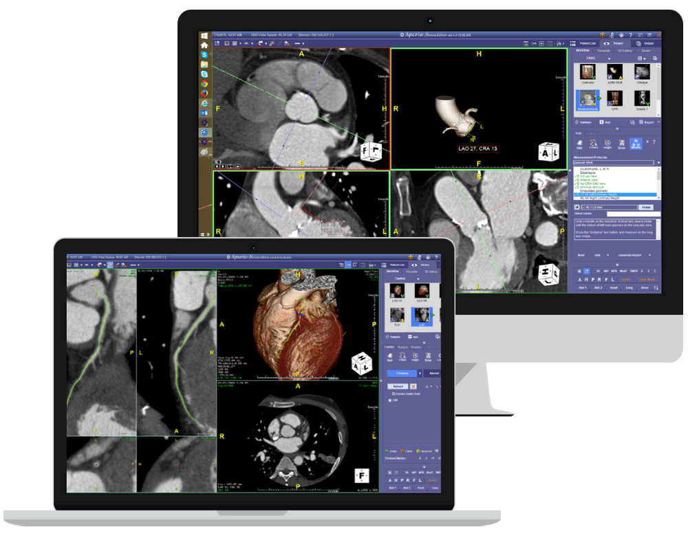 CT Cardiac Advanced Visualization Package | Terarecon